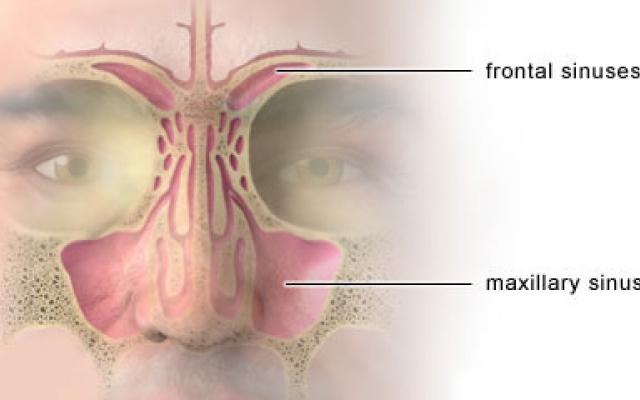 Sinusitis: síntomas y tratamiento del dolor – Bupa